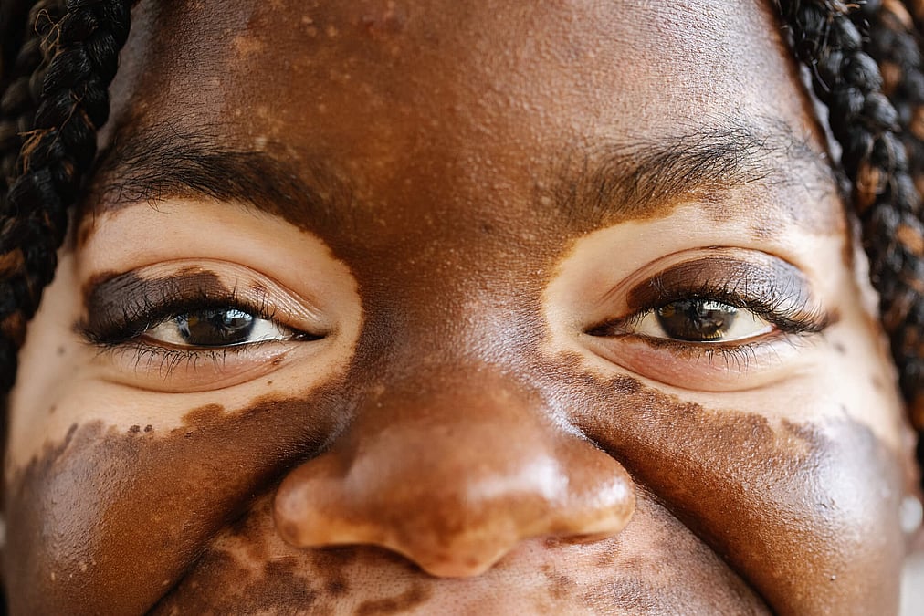 World Vitiligo Day (June 25th) | Days Of The Year