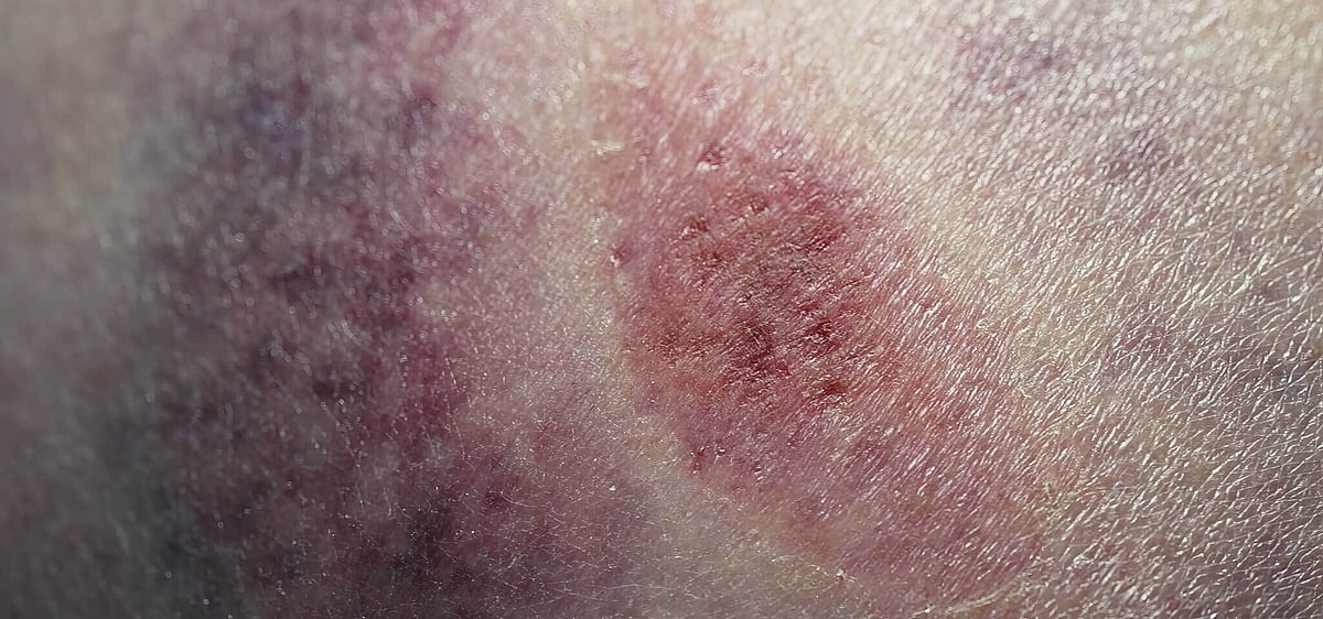 Necrotizing Fasciitis Awareness Day (May 31st) | Days Of The Year