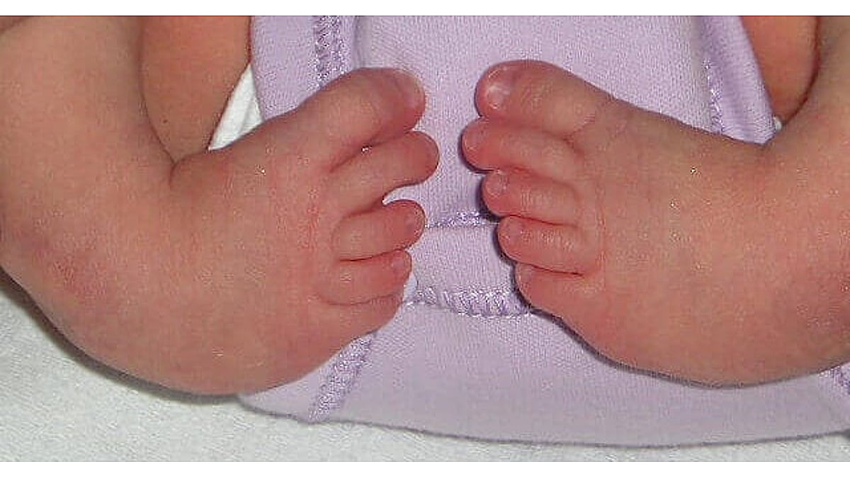 World Clubfoot Day (June 3rd) | Days Of The Year